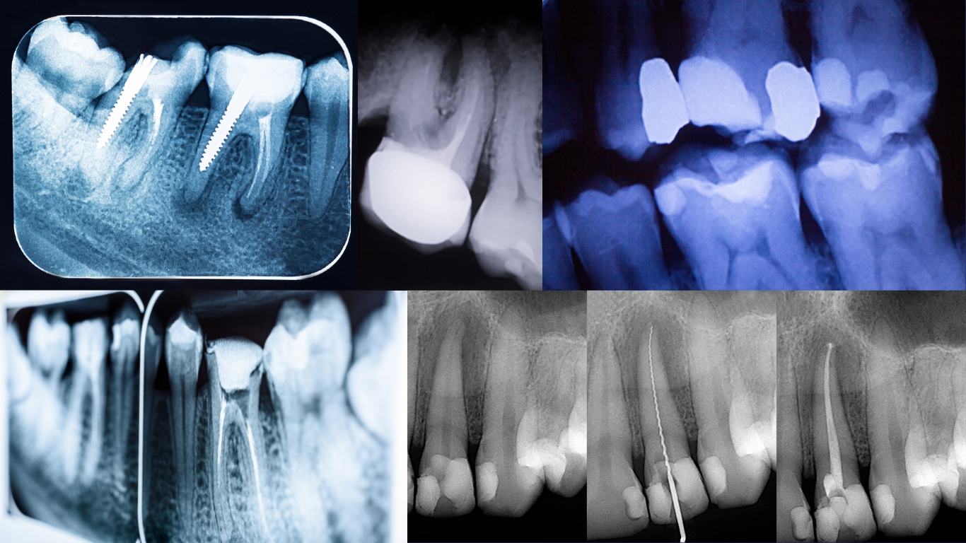 Choosing the Right RVG Sensor: A Guide to Sizes and Shapes